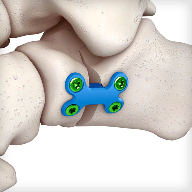 Evans Osteotomy Plates - Unite Foot and Ankle