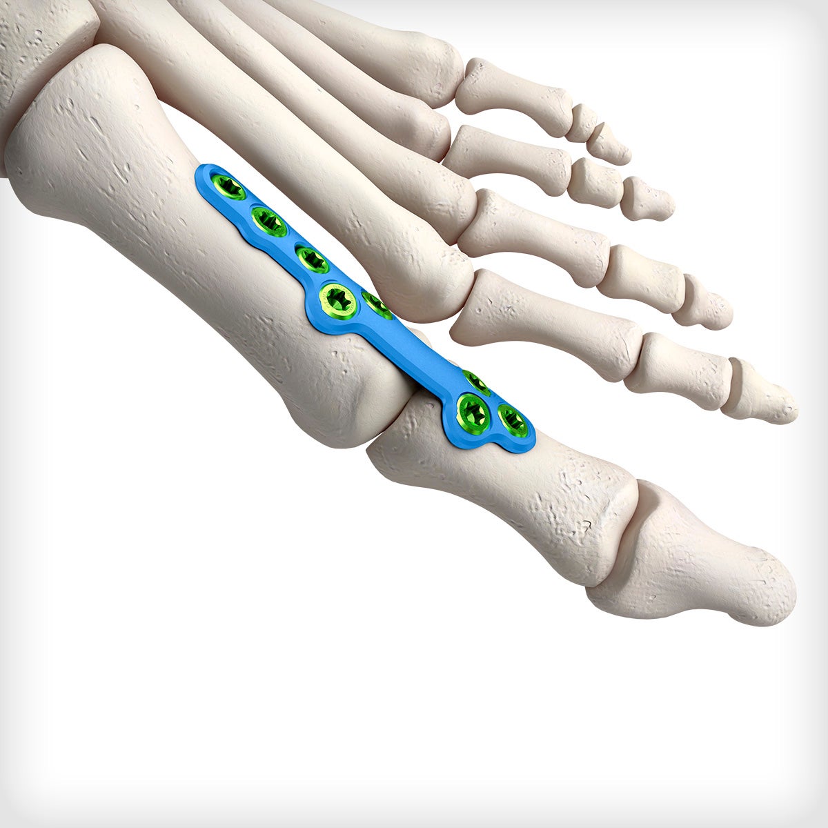 MTP Fusion Plates - Unite Foot and Ankle