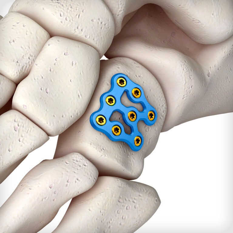 Cuboid Fracture Plate - Unite Foot and Ankle