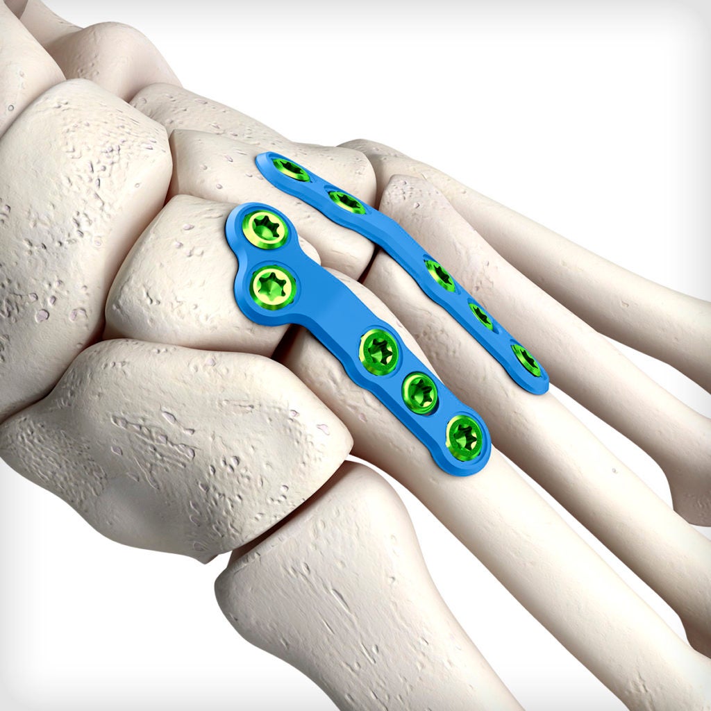 TMT Fusion Plates - Unite Foot and Ankle