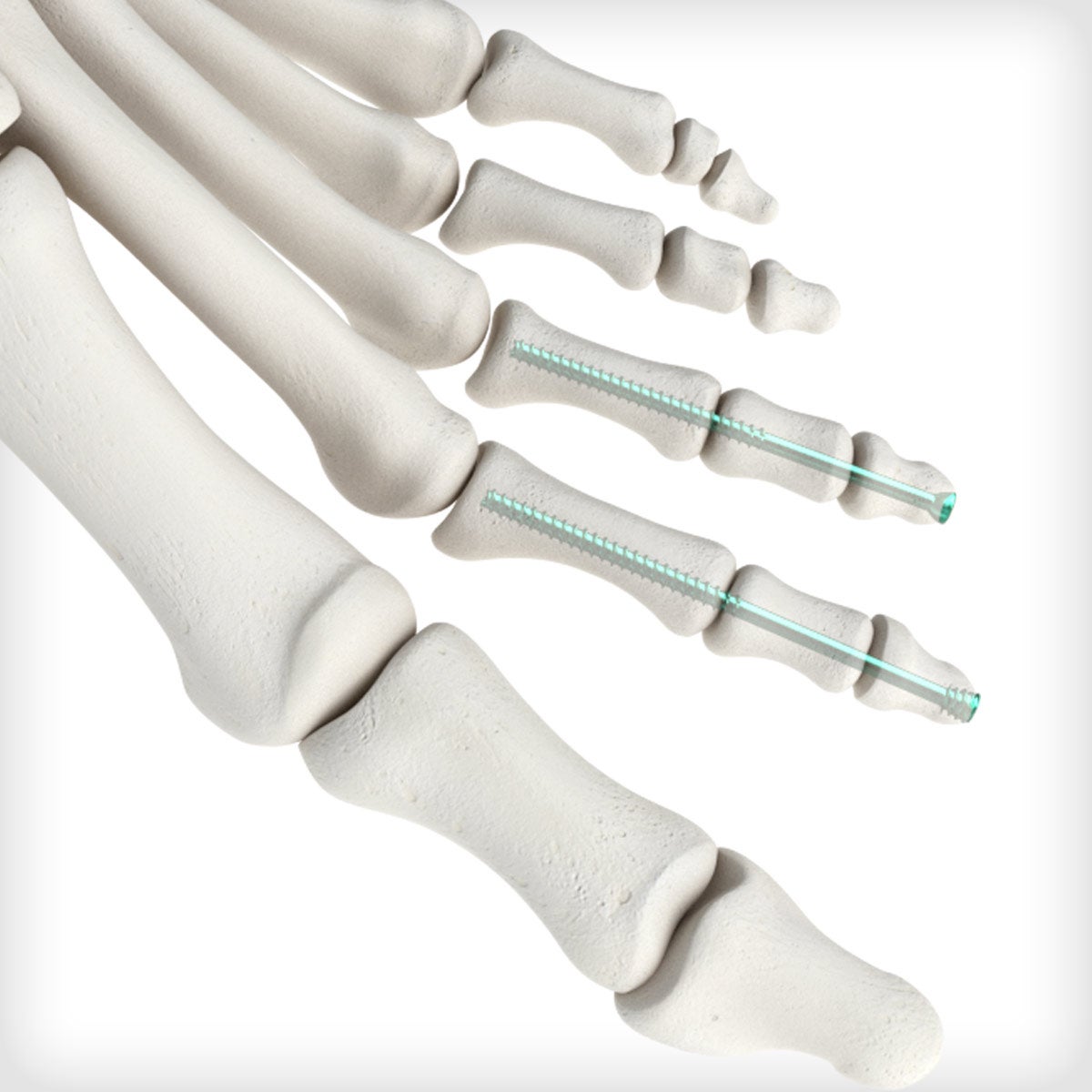 Digital Fusion Implants - Unite Foot and Ankle